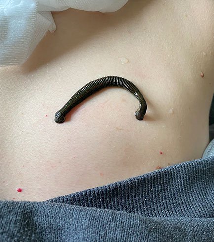 Hirudothérapie : Bienfaits des Sangsues pour la Santé